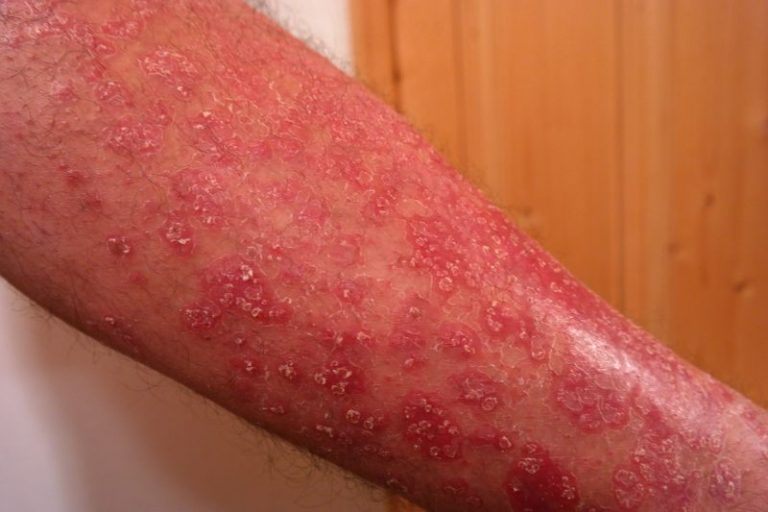 Dermatitis herpetiforme | Qué es, diagnóstico, tratamiento, síntomas ...