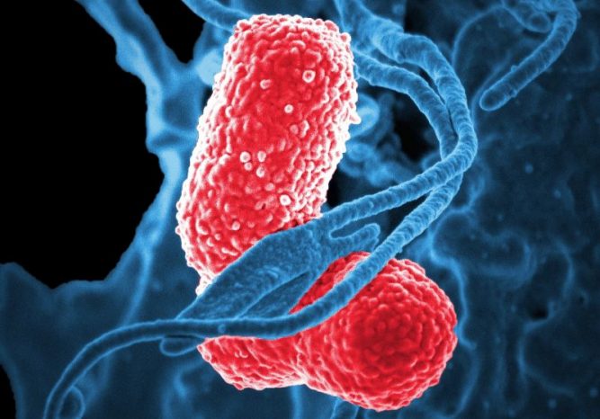 Bronconeumonía | Qué es, diagnóstico, tratamiento, causas