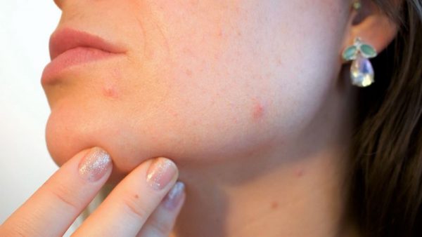 Cómo quitar las espinillas | Aprende a eliminarlas y a prevenir su ...