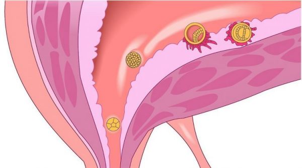 Traquelectomía | Qué es, definición, pronóstico | Simple, radical | Utero