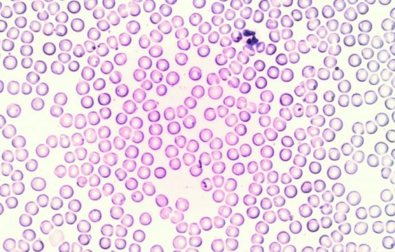 Eosinófilos | Qué es, definición, función, estructura, formación, altos ...