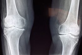 Cóndilo | Qué es, ubicación, afección, fractura, tratamiento