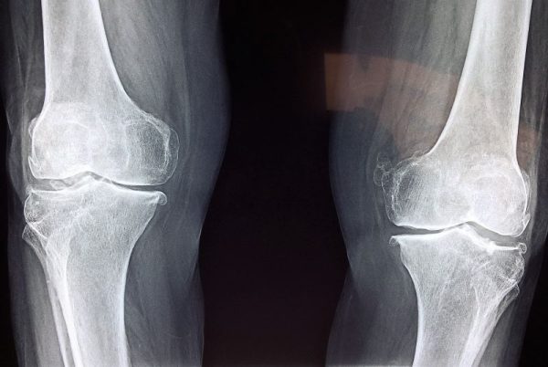 Cóndilo | Qué es, ubicación, afección, fractura, tratamiento