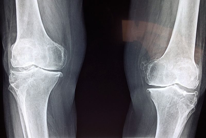 Cóndilo | Qué es, ubicación, afección, fractura, tratamiento